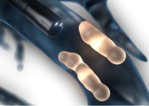 New Broncoflex - Alpha MedTech Limited